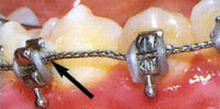 Life with Braces | Orthodontist in Orlando, FL